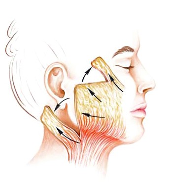 Lifting (face lift) trivettoriale ultrasonico | Studio del Dottor ...